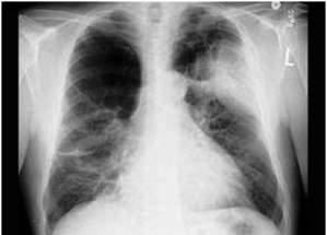 Hronicna obstruktivna bolest pluca | SEMINARSKI RAD IZ MEDICINE